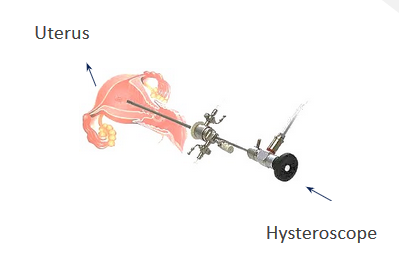 Fertility Enhancing Surgery – The Hugh Wynter FMU